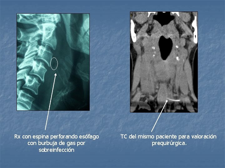 Cursotaller de exploracin larngea Laringoscopia indirecta Laringoscopia ...