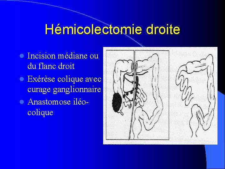 Pathologies chirurgicales du Colon et du Rectum Davide