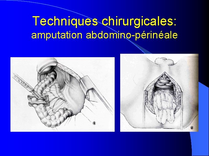 Pathologies chirurgicales du Colon et du Rectum Davide