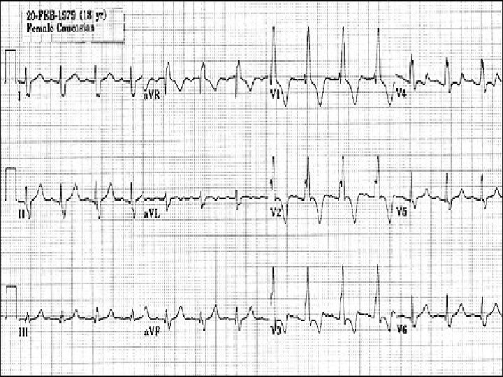 MAKING ECGS EASY APPLICATION FOR THE ECG EVALUATING
