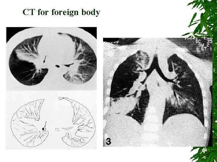 Practical approach to the pediatric chest Xray Valoraction