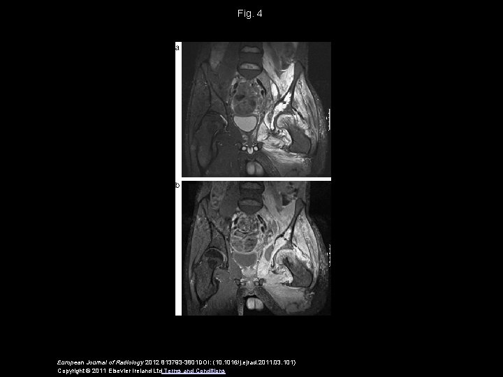Bone and soft tissue tumors of hip and