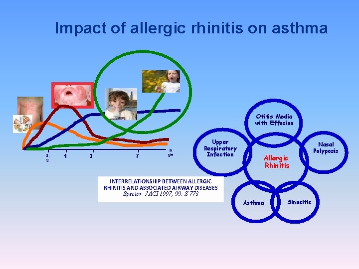 Impact of allergic rhinitis on asthma Otitis Media
