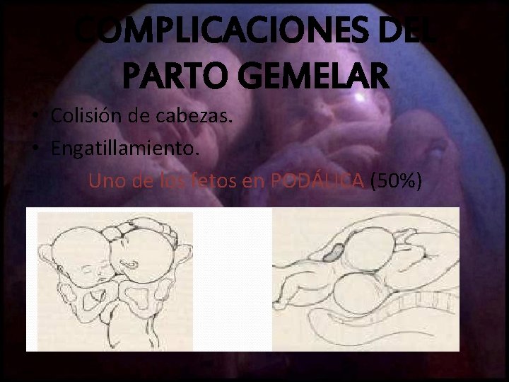 EL PARTO GEMELAR Karla Ferreres Garca MIR I