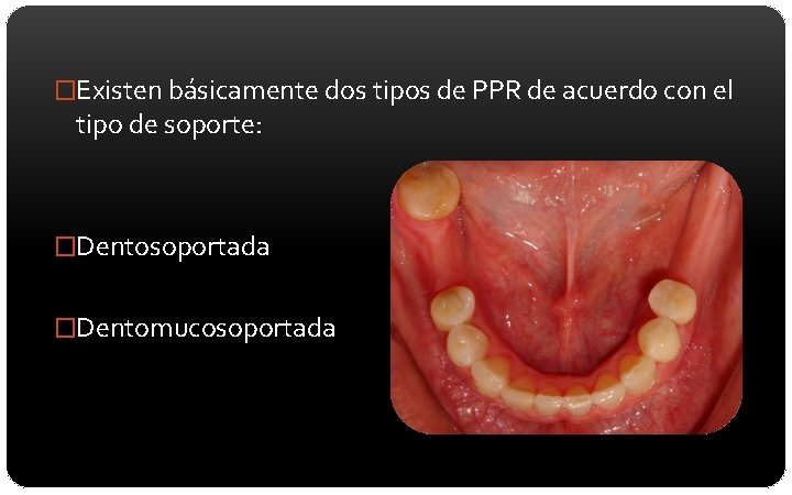 PPR Dentosoportada y Dentomucosoportada Dr Kaleb Diaz Existen