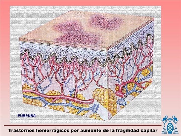 TRASTORNOS HEMORRGICOS POR AUMENTO DE LA FRAGILIDAD CAPILAR