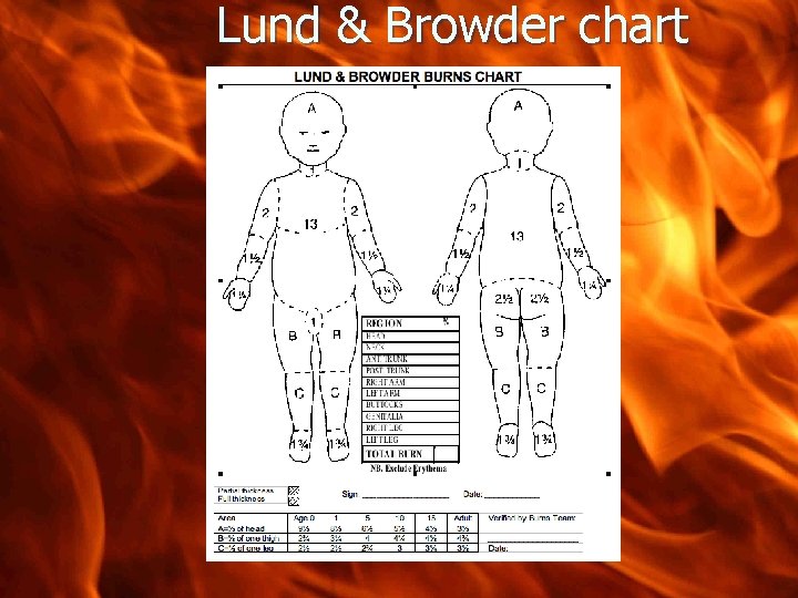 Management of severe burns Who gets admitted to