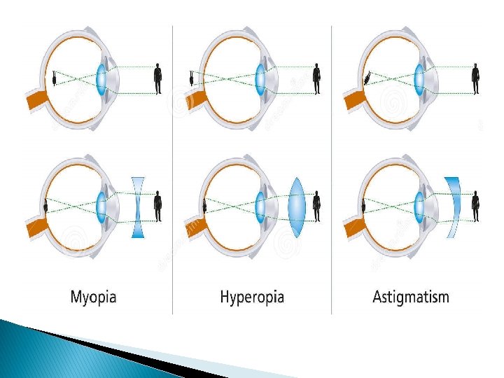 Facts in correction of ametropia Gamal Abdellatief Radwan