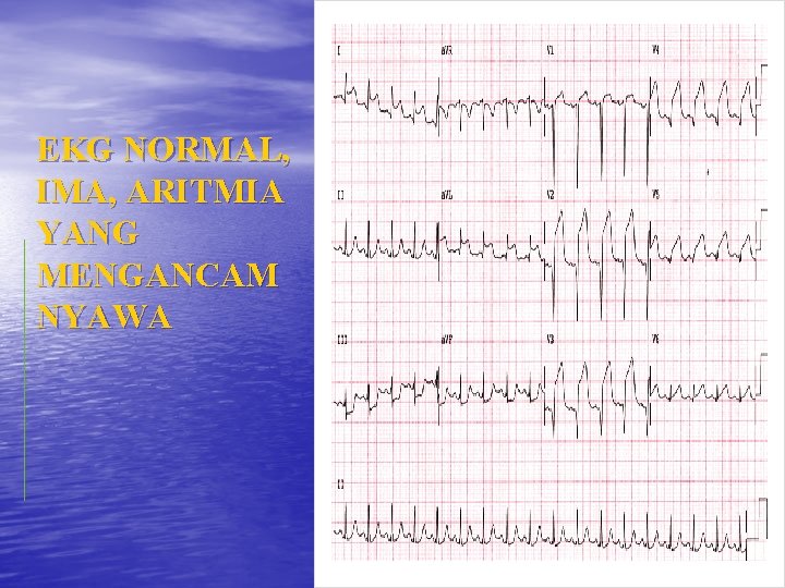 EKG NORMAL IMA ARITMIA YANG MENGANCAM NYAWA ANATOMI