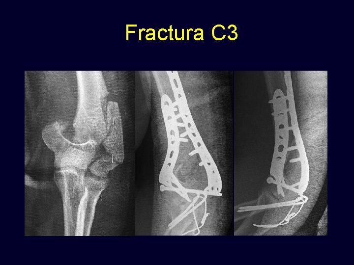Fracturas Complejas Hmero Distal C 3 3 Alfredo
