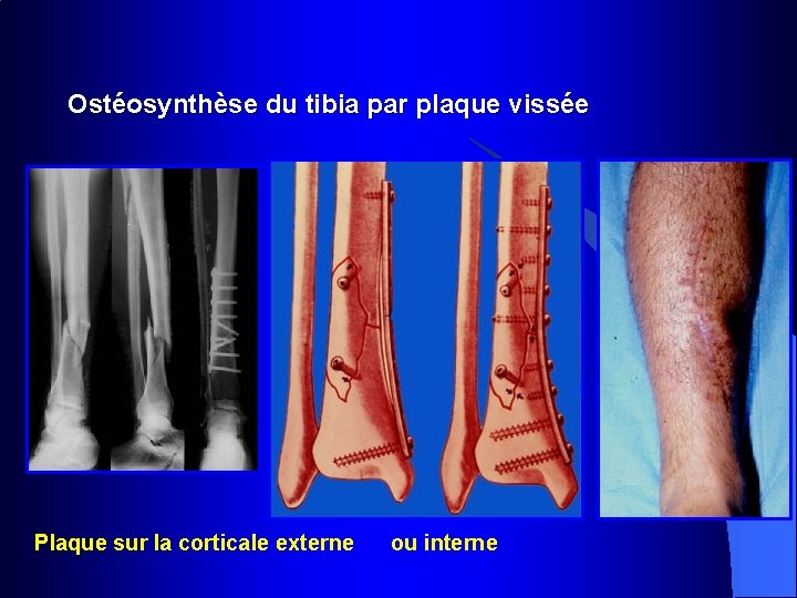 Principe de traitement des fractures Gregory Moineau Nicolas