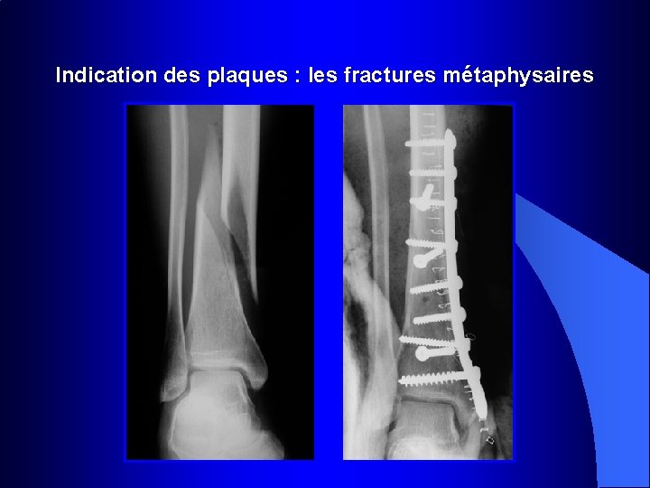 Principe de traitement des fractures Gregory Moineau Nicolas