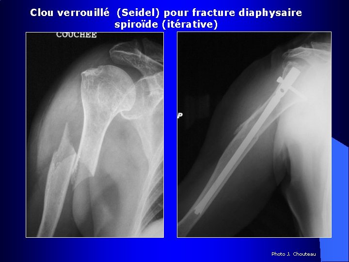 Principe de traitement des fractures Gregory Moineau Nicolas