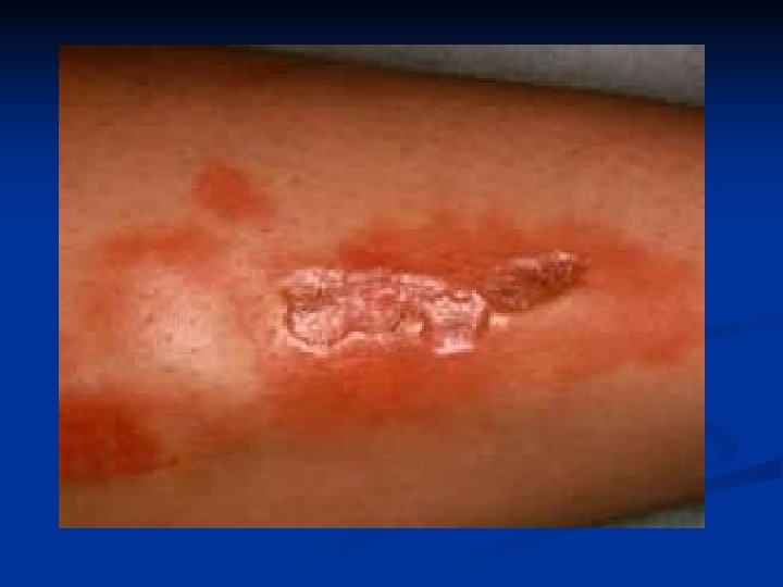 Cellulitis and Soft Tissue Infections Pamela Orr Professor