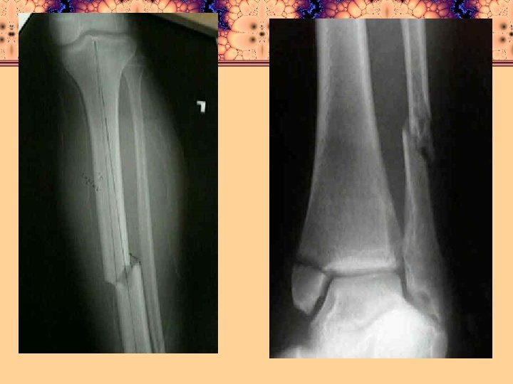 Broken Bones A few common types Is it