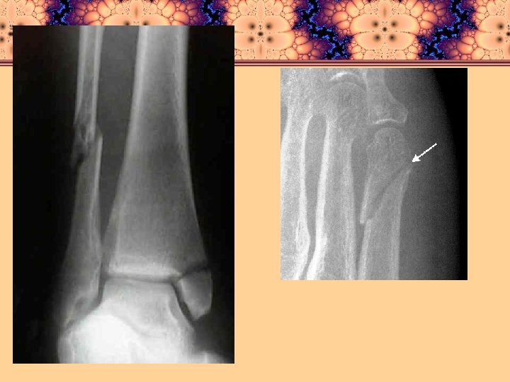 Broken Bones A few common types Is it