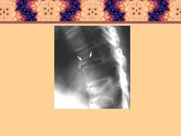 Broken Bones A few common types Is it