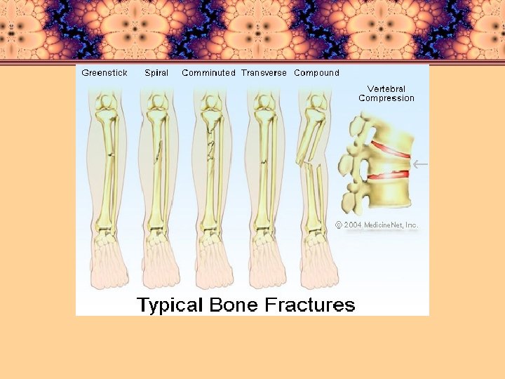 Broken Bones A few common types Is it