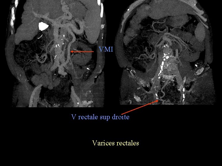 VASCULARISATION DU TUBE DIGESTIF PCEM 2 2011 Olivier