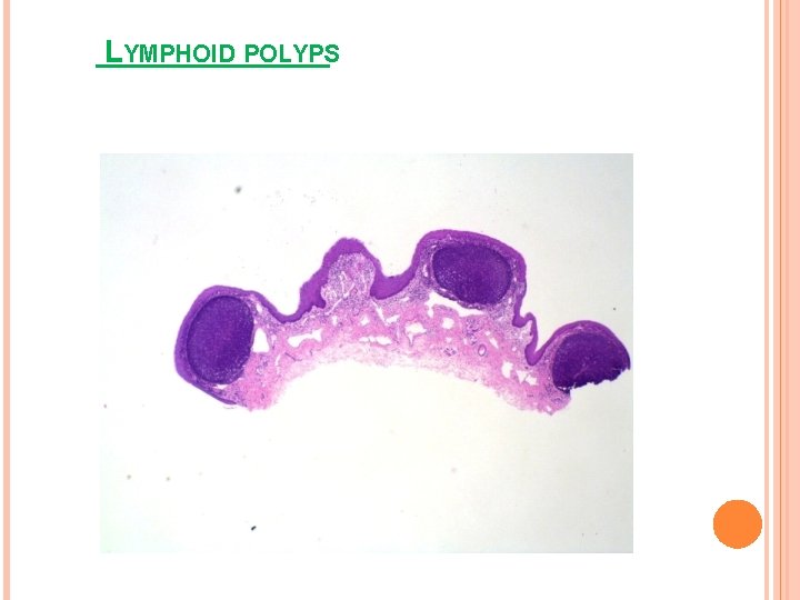 GASTROINTESTINAL BLOCK PATHOLOGY LECTURE 2015 Benign Tumors of