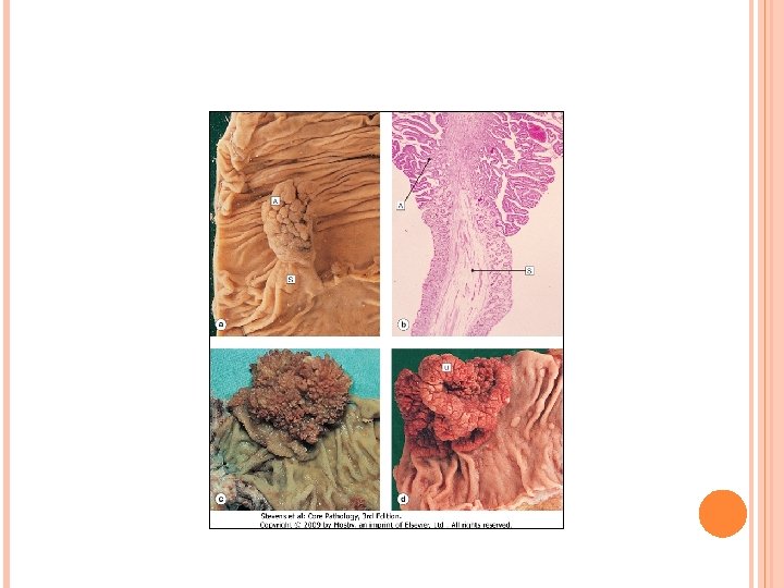GASTROINTESTINAL BLOCK PATHOLOGY LECTURE 2015 Benign Tumors of