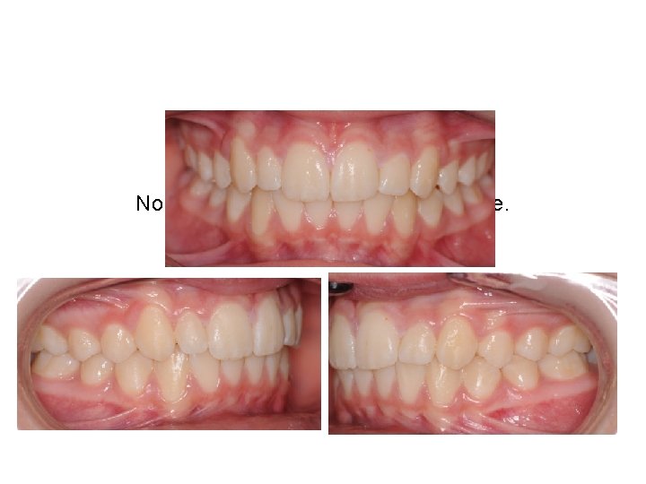 Simple class II corrector study cases Case 1