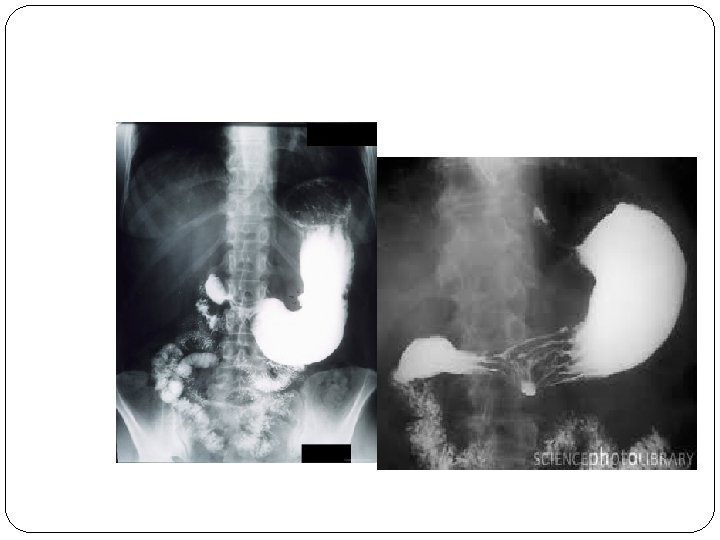 Chronic gastritis Peptic ulcer of a stomach and