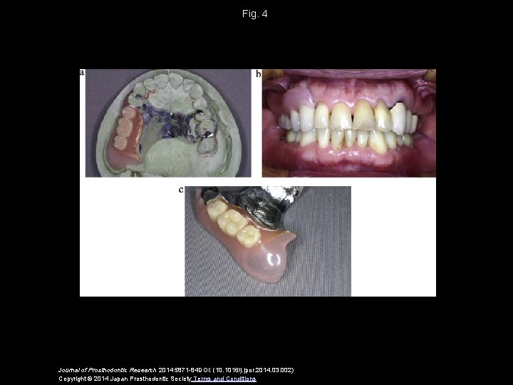 Clinical application of removable partial dentures using thermoplastic