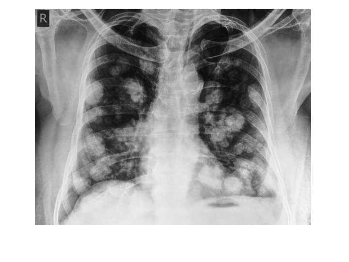 Review of Common Radiographs Pneumoperitoneum Air under the