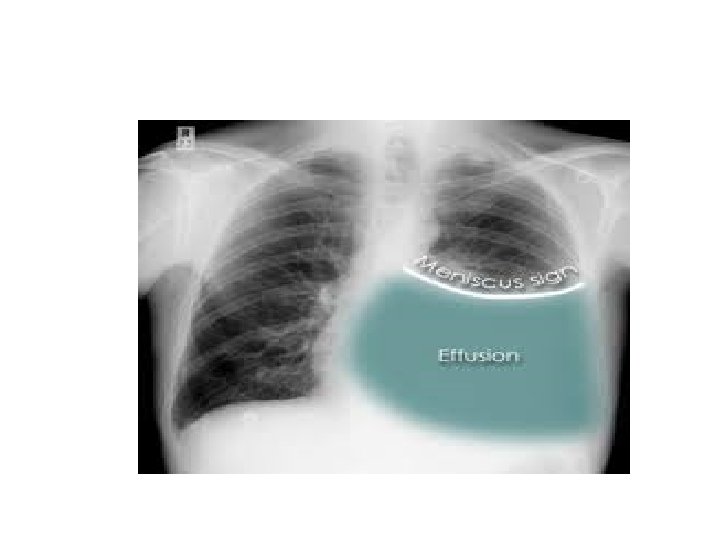 Review of Common Radiographs Pneumoperitoneum Air under the