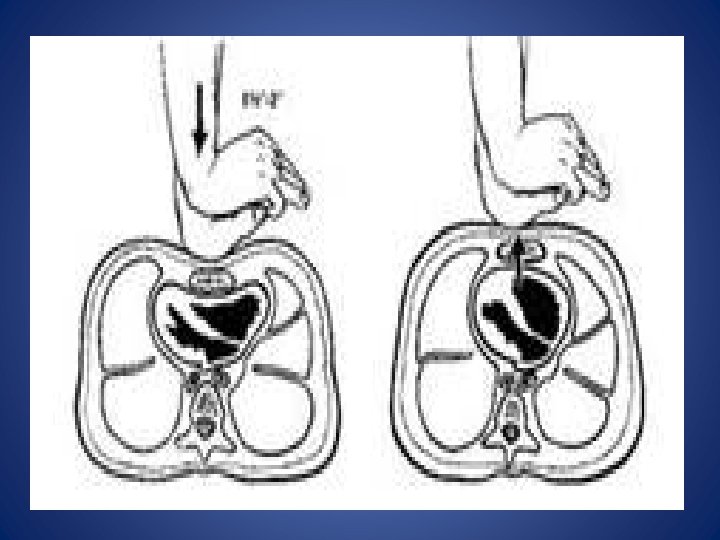 HandsOnly CPR Objectives Recognize the signs and symptoms