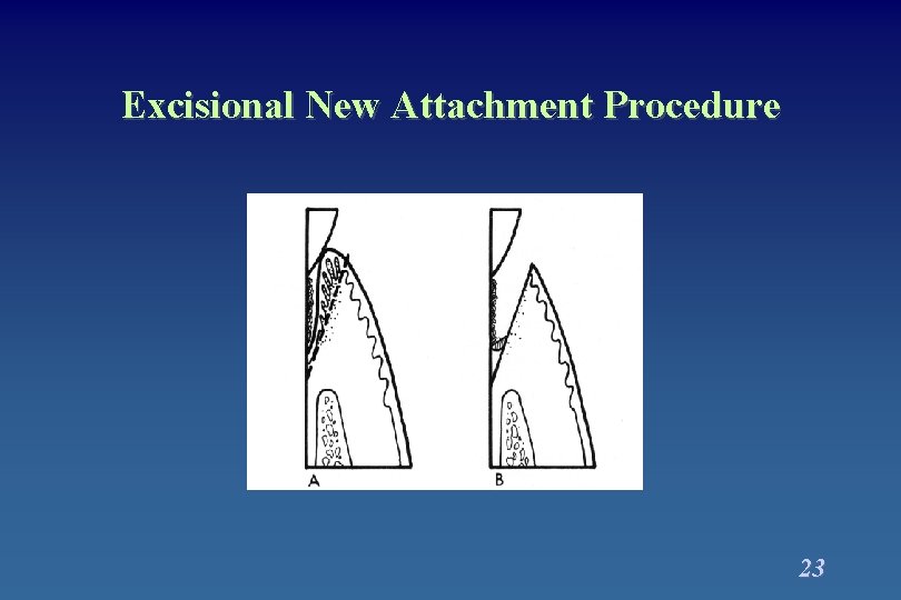 Basic Instruments for Periodontal Charting Dental mirrors Cotton