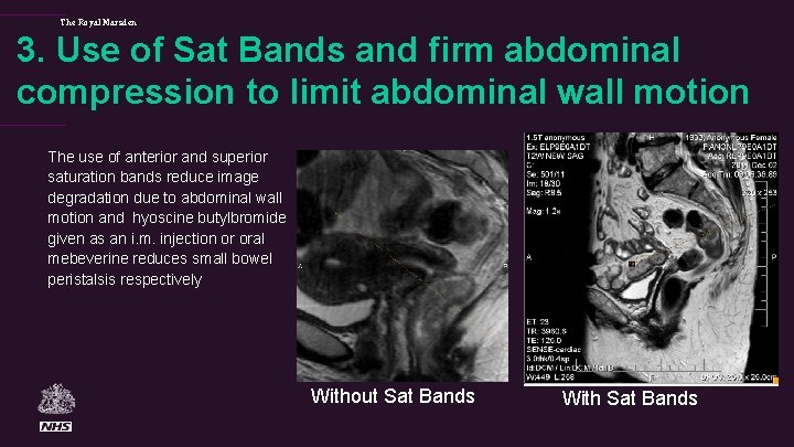 MRI techniques for rectal cancer staging and standardisation