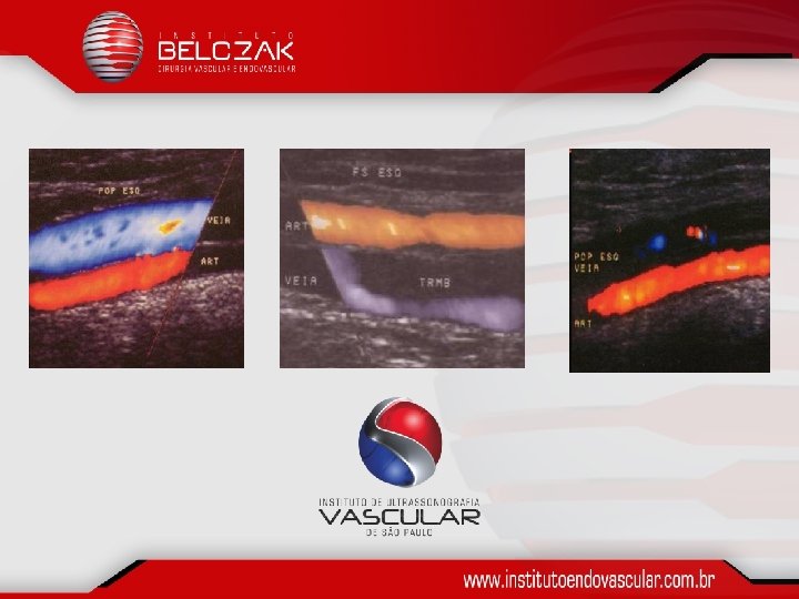 Aula 7 Trombose Venosa Profunda Prof Sergio Belczak