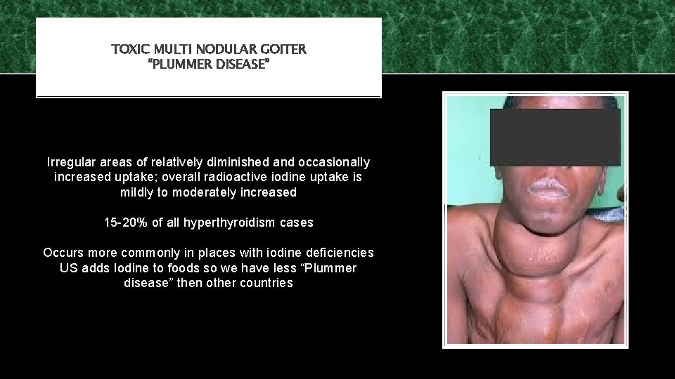 HYPERTHYROIDISM Shannon Galey University of South Florida Med