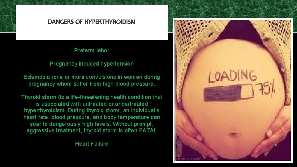 HYPERTHYROIDISM Shannon Galey University of South Florida Med