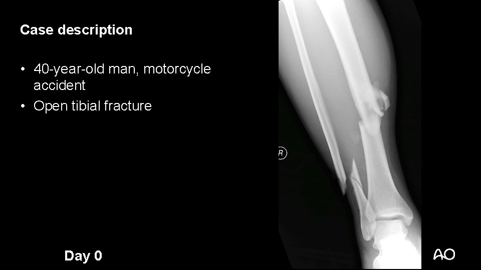 Infectiondecision making in difficult fracture problems Case for