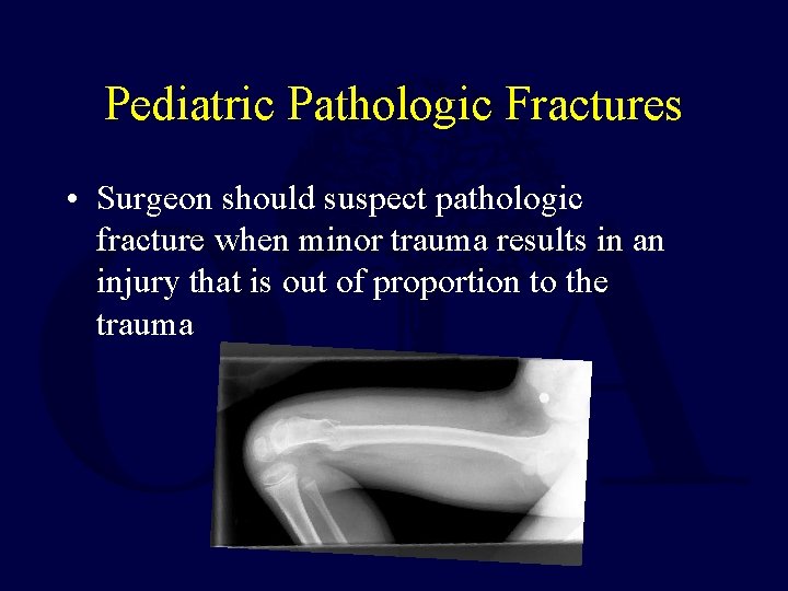 Pediatric Pathologic Fractures Zeke J Walton M D