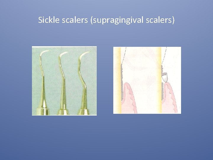 SCALING AND ROOT PLANING LEARNING OBJECTIVES Classification of