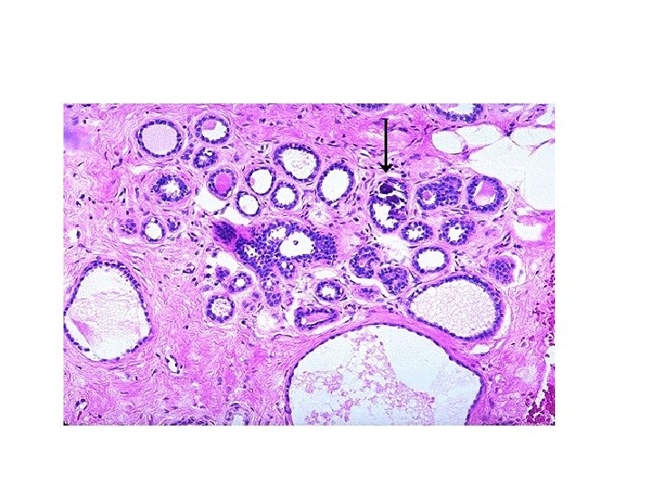 Benign breast diseases Dr farhana ACUTE MASTITIS Occur