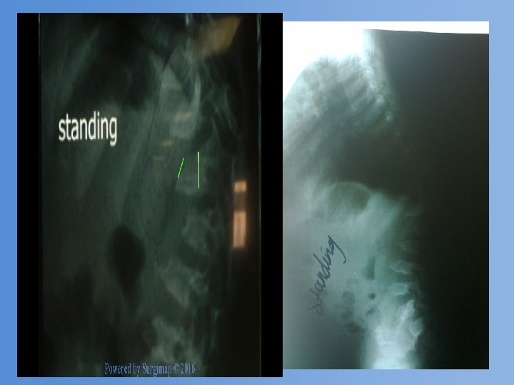 Vertebral Remodeling Through posterior tethering technique Technique ...