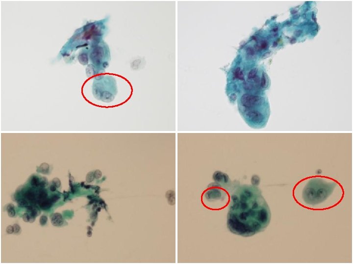 Microscopical features Paucicellular aspirate Small and large loosely