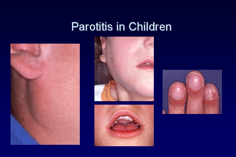 Oral Manifestations of Pediatric HIV Infection Clinical Characteristics