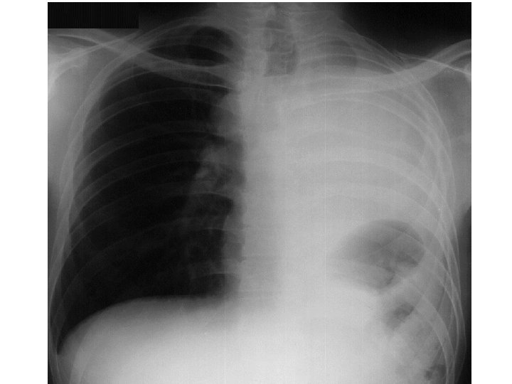 Syndrome radiologique Le syndrome parital Ensemble des signes