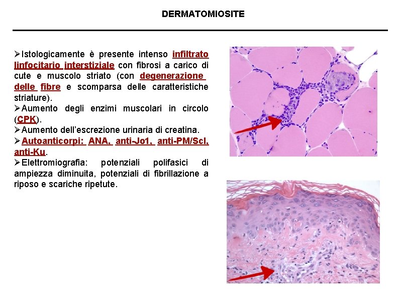 CASO CLINICO CANCRO OVARICO E DERMATOMIOSITE Sindromi paraneoplastiche