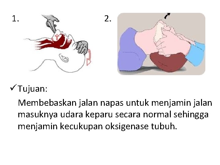 Membuka jalan napas dengan alat OPA atau tanpa
