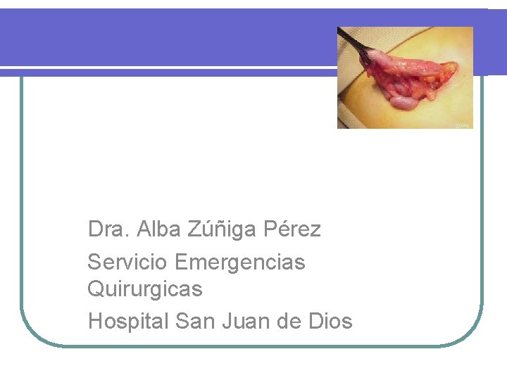 Apendicitis Aguda Dra Alba Ziga Prez Servicio Emergencias