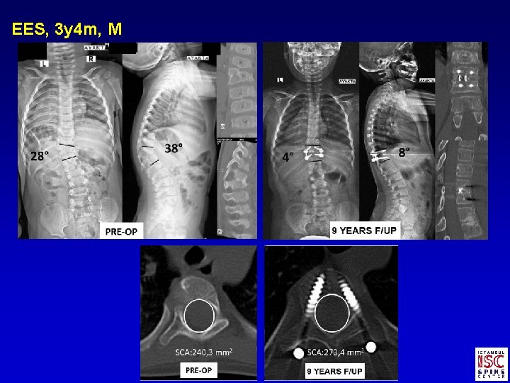 POSTERIOR HEMIVERTEBRA RESECTION AND SHORT SEGMENT FUSION WITH
