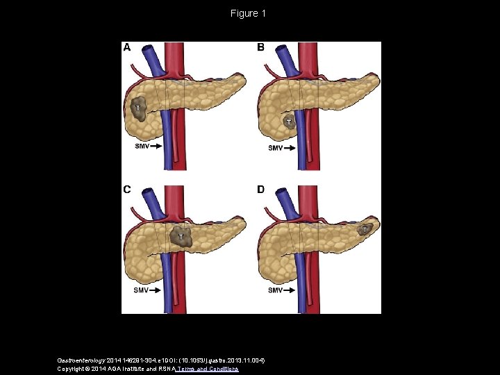 Pancreatic Ductal Adenocarcinoma Radiology Reporting Template Consensus ...