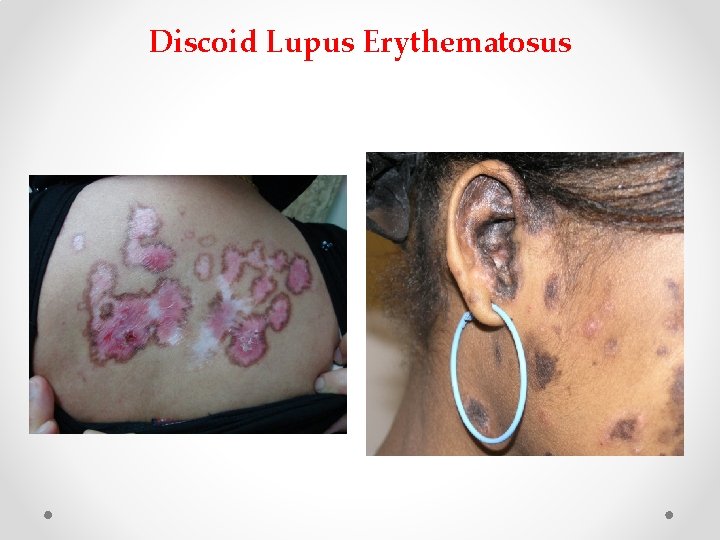 Cutaneous manifestation of SLE and other CTD Diseases